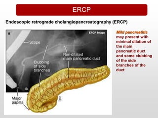 Chronic Pancreatitis Ercp