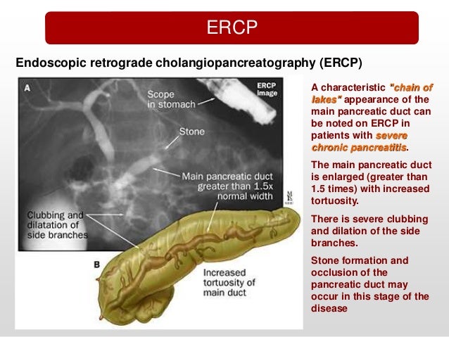 Chronic Pancreatitis