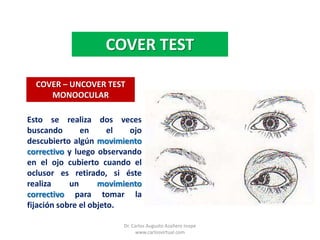 Pruebas De Alineacion Ocular | PPTX