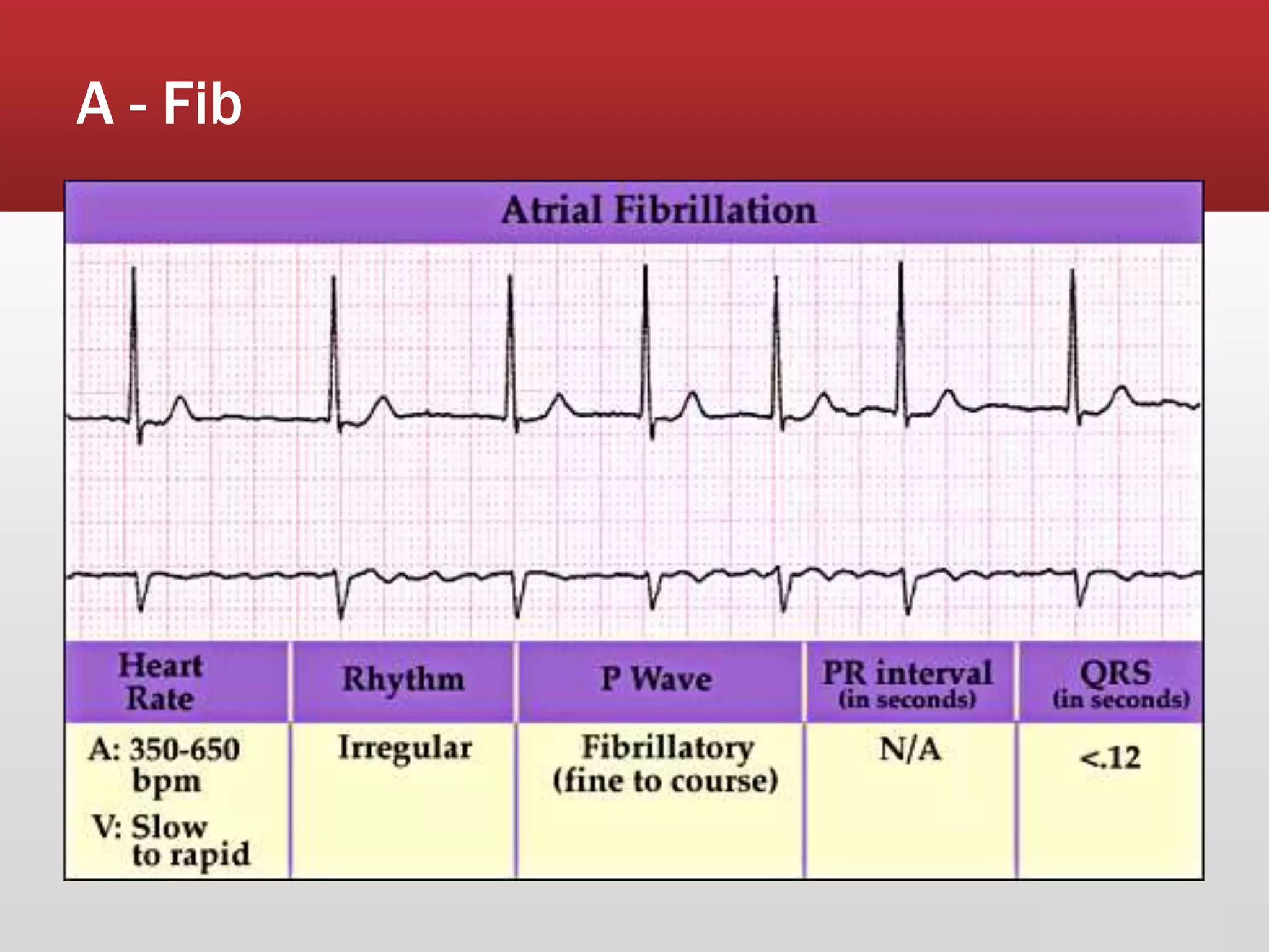 ECG BASICS AND ARRTHYMIAS | PPTX