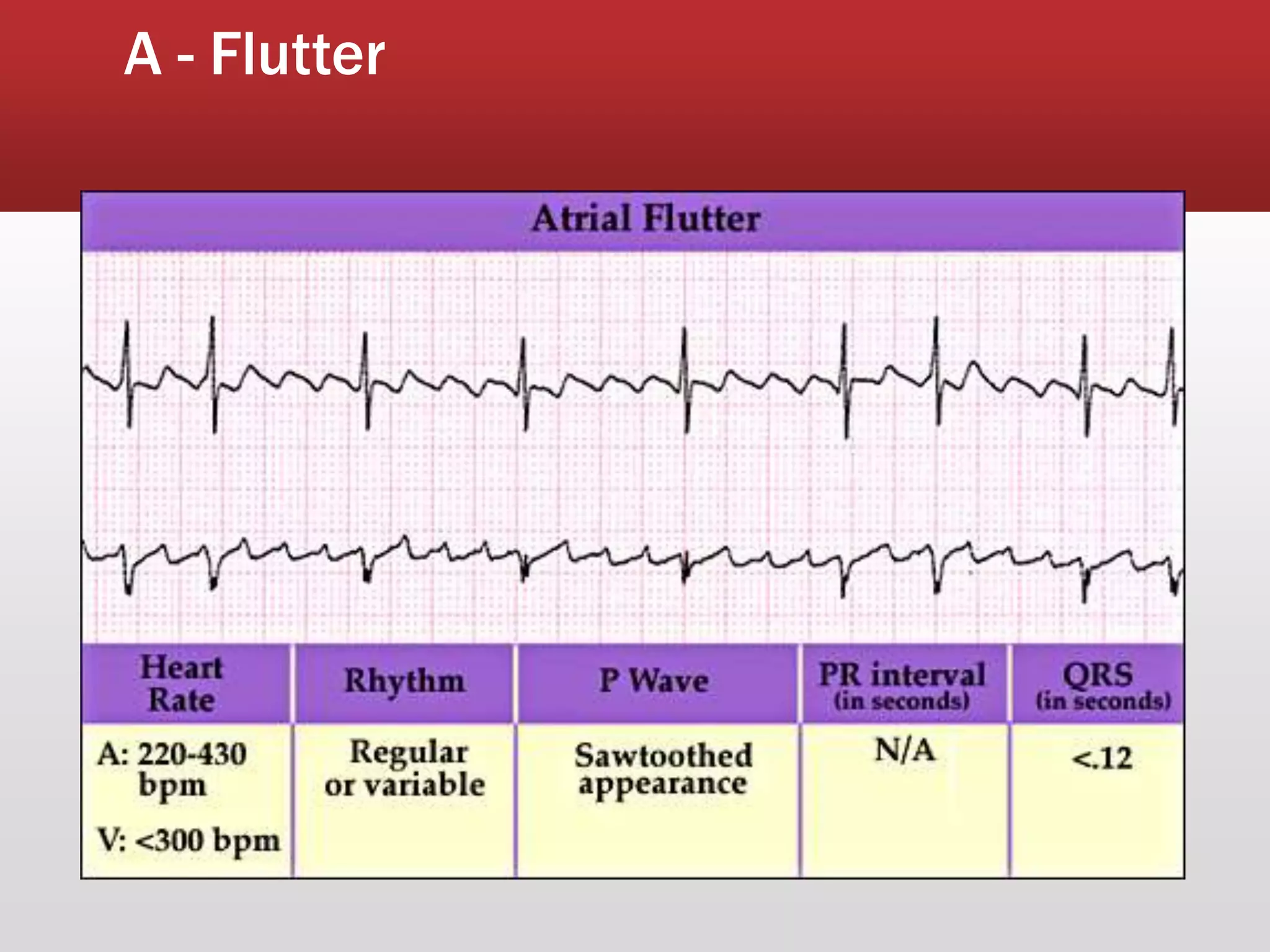 ECG BASICS AND ARRTHYMIAS | PPTX