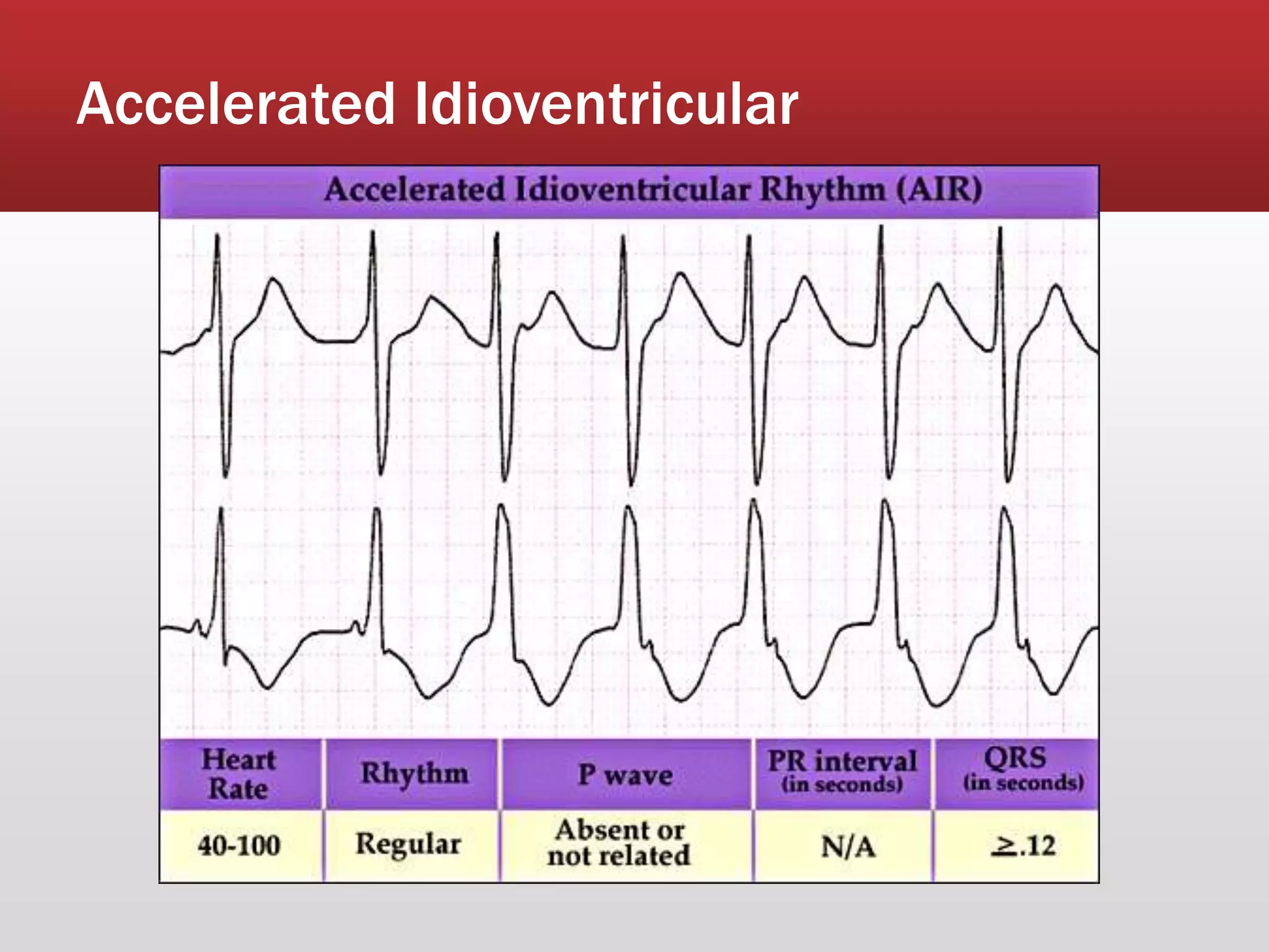 ECG BASICS AND ARRTHYMIAS | PPTX
