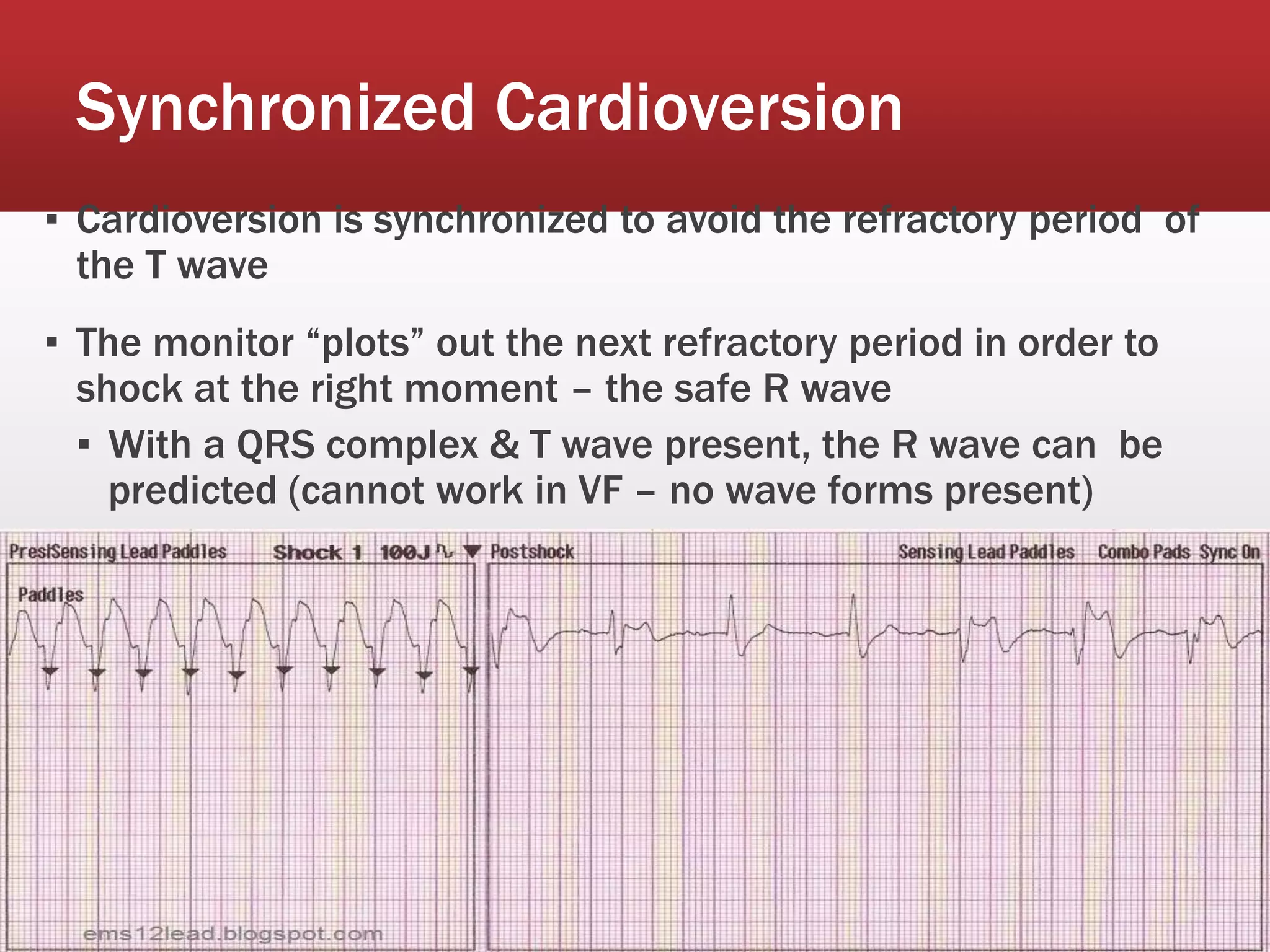 ECG BASICS AND ARRTHYMIAS | PPTX