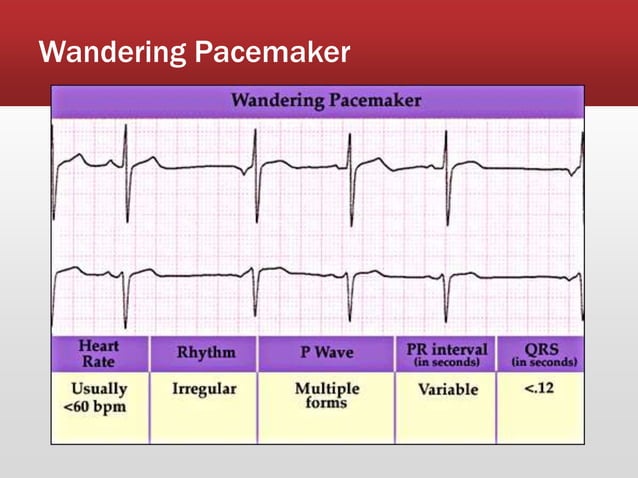 ECG BASICS AND ARRTHYMIAS | PPT