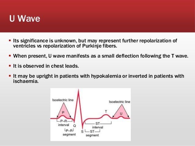 ECG BASICS AND ARRTHYMIAS