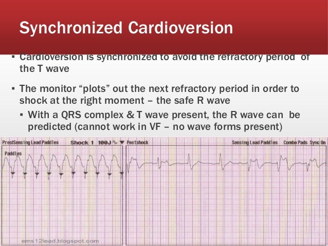 ECG BASICS AND ARRTHYMIAS