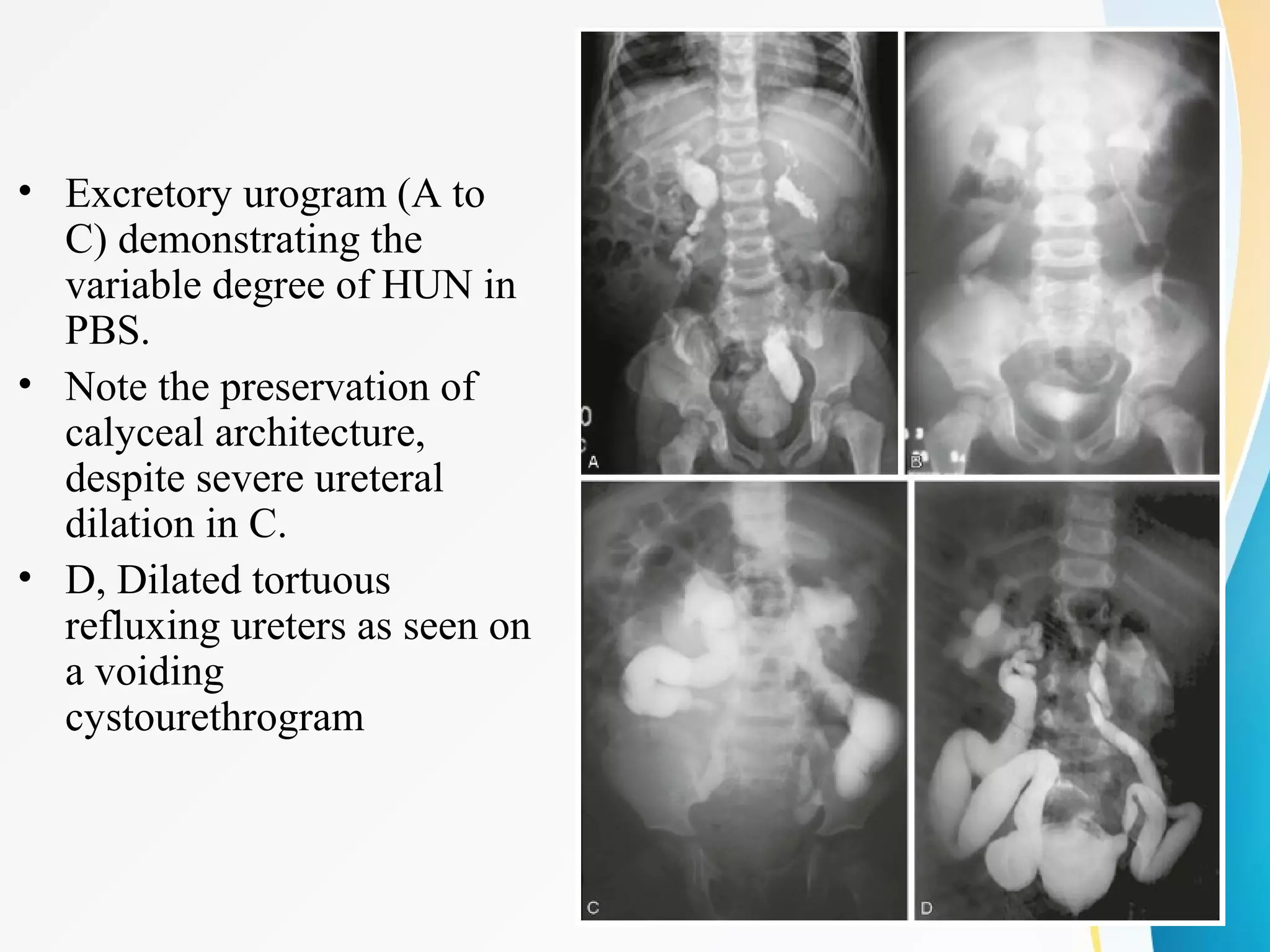 Prune belly syndrome | PPT