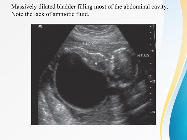 Prune belly syndrome | PPT | Pregnancy | Reproductive Health