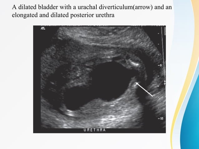 Prune belly syndrome | PPT | Pregnancy | Reproductive Health
