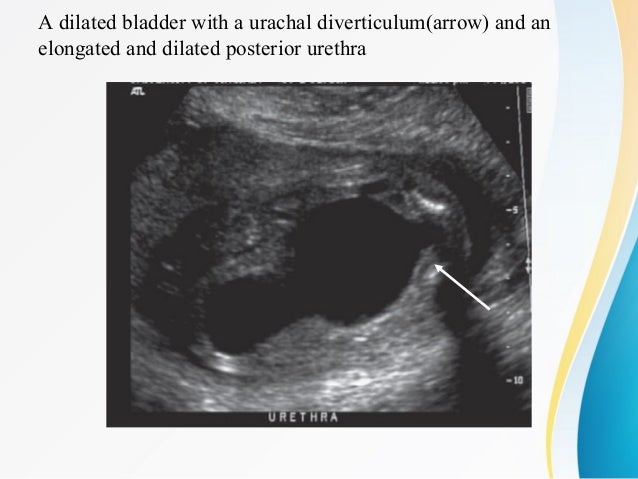 Prune Belly Syndrome