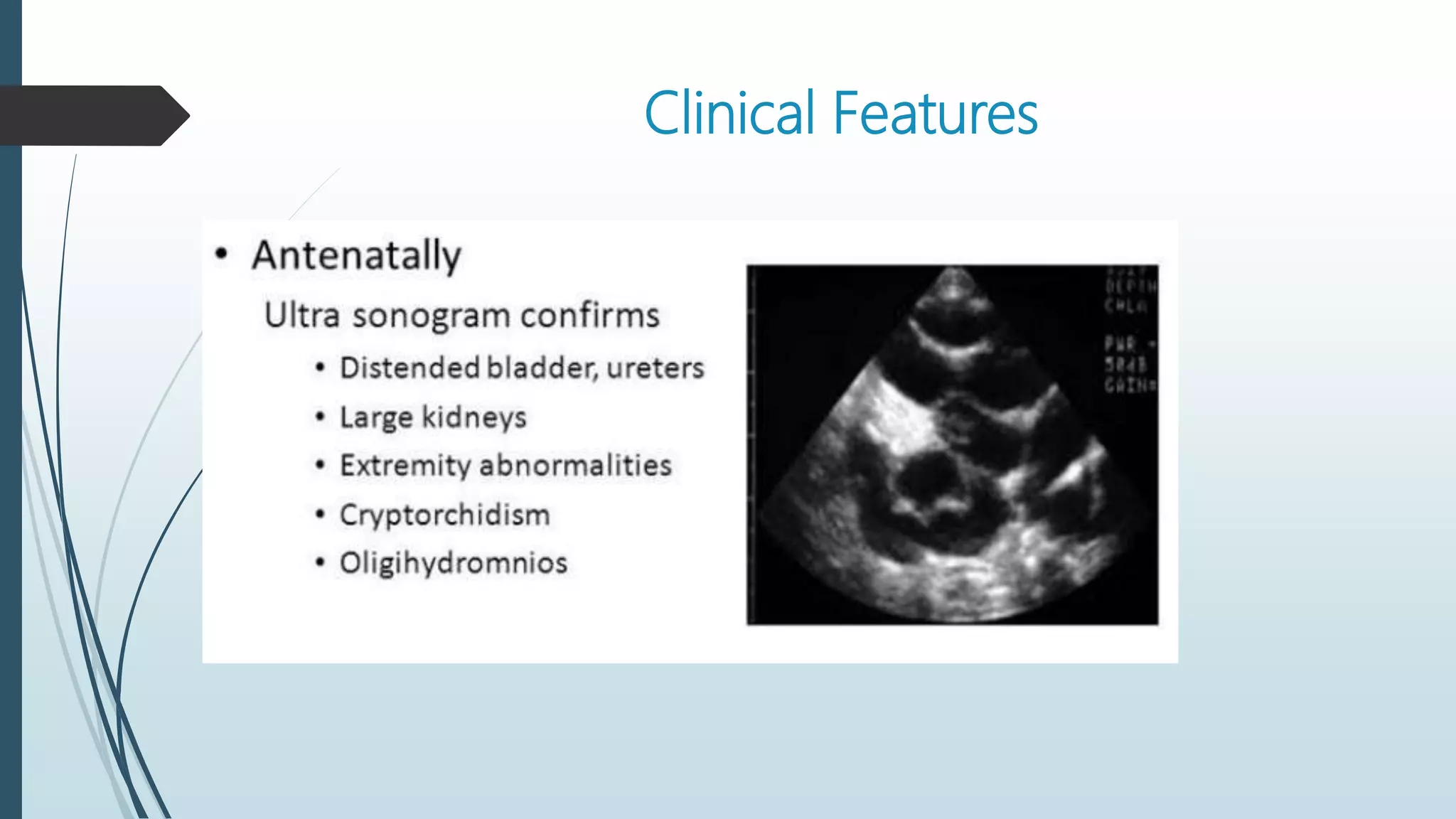 Prune belly syndrome | PPTX