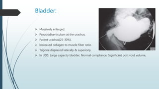 Prune belly syndrome | PPTX