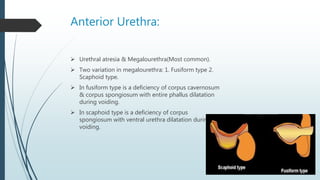 Prune belly syndrome | PPTX
