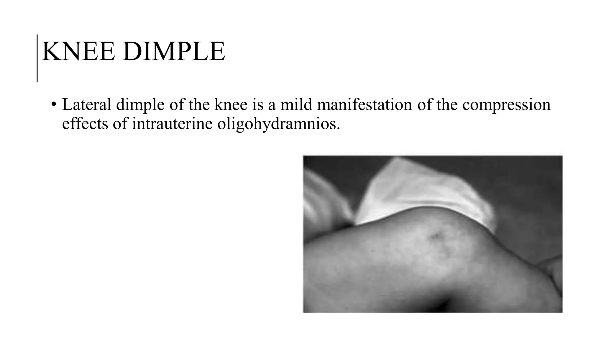 A ppt about the Prune Belly Syndrome.pptx
