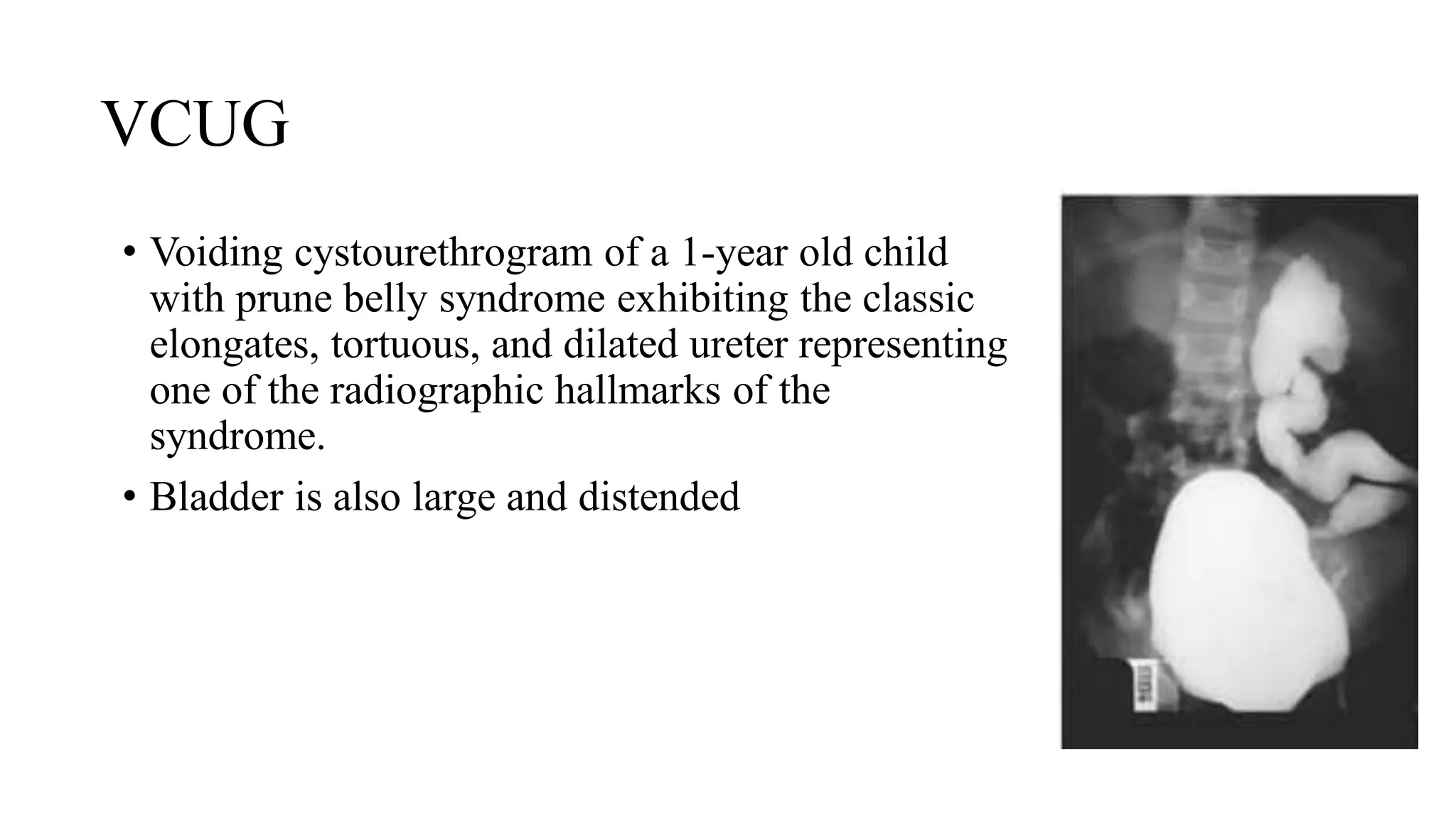A ppt about the Prune Belly Syndrome.pptx