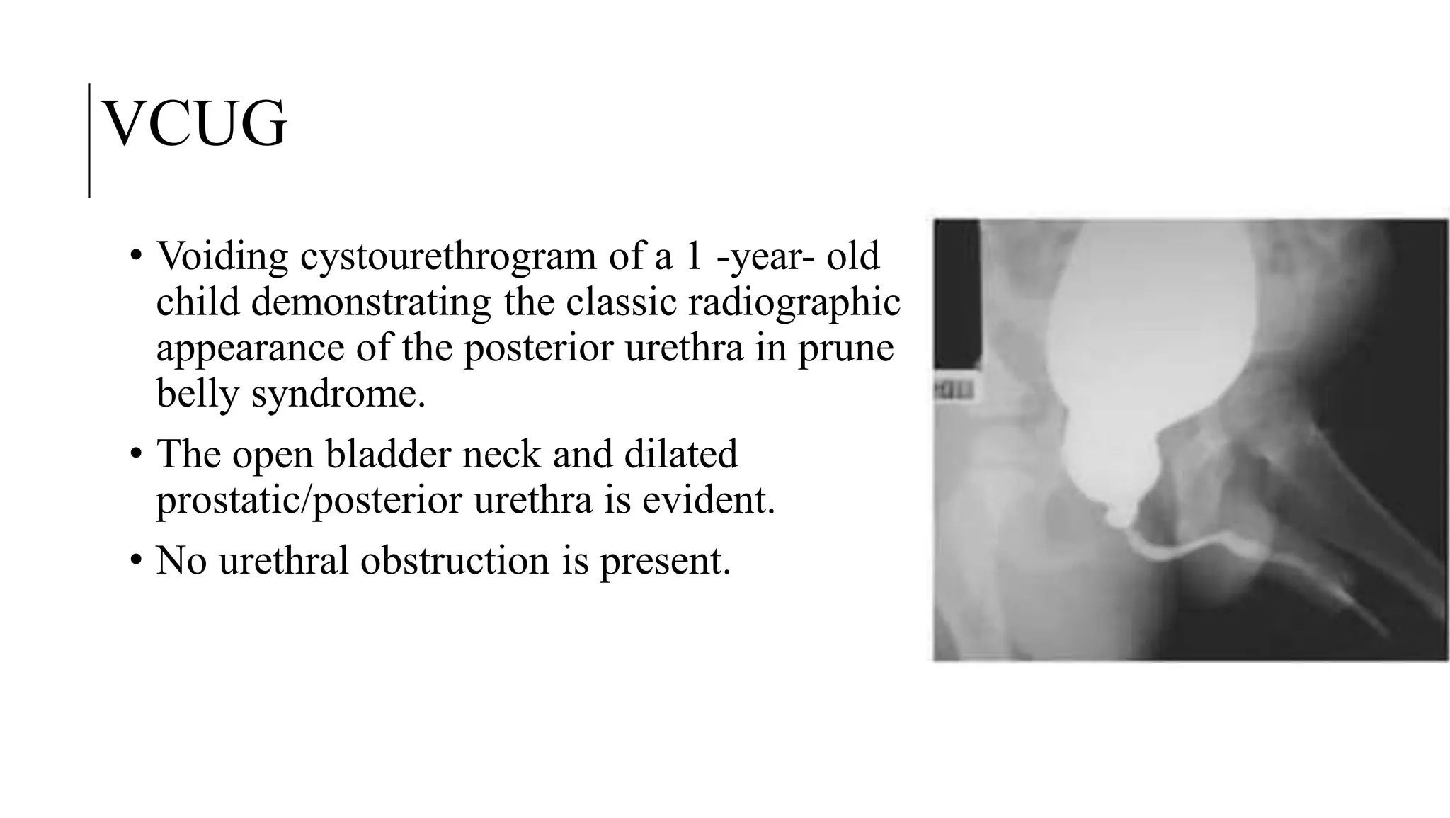 A ppt about the Prune Belly Syndrome.pptx