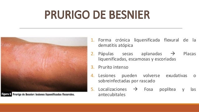 Prurigo agudo, subagudo y crónico