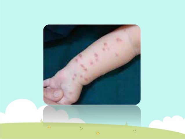 Prurigo por insectos