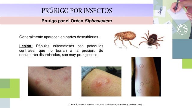 Prurigo por insectos