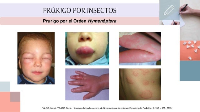 Prurigo por insectos