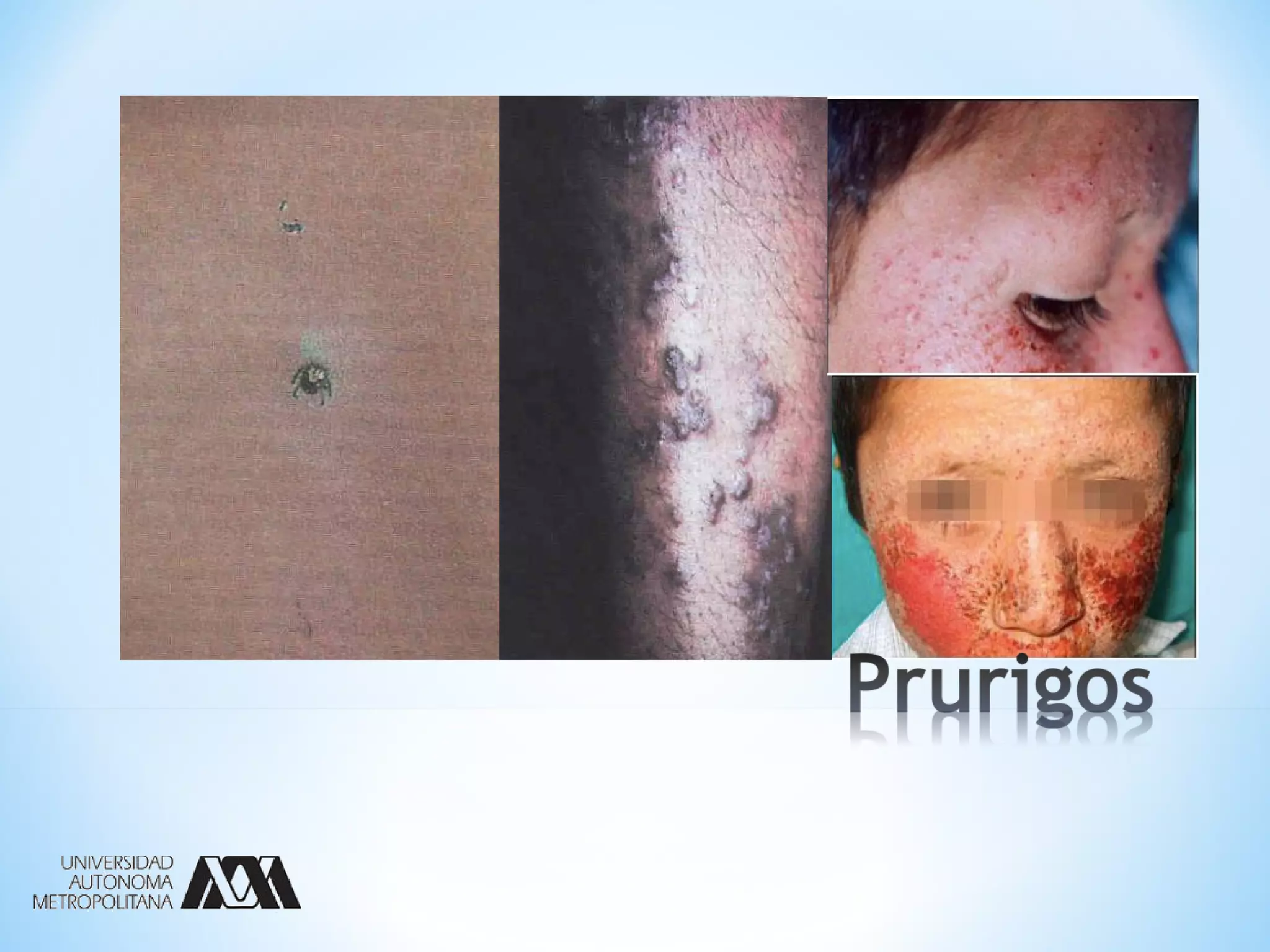 Dermatologia: Prurigo por insectos, nodular y actínico | PPT
