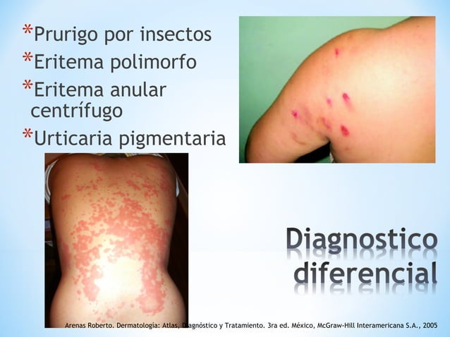 Dermatologia: Prurigo por insectos, nodular y actínico