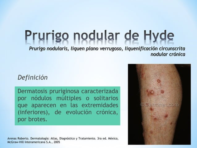 Dermatologia: Prurigo por insectos, nodular y actínico