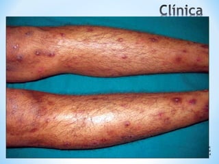 Dermatologia: Prurigo por insectos, nodular y actínico