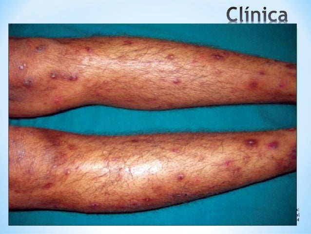 Dermatologia: Prurigo por insectos, nodular y actínico