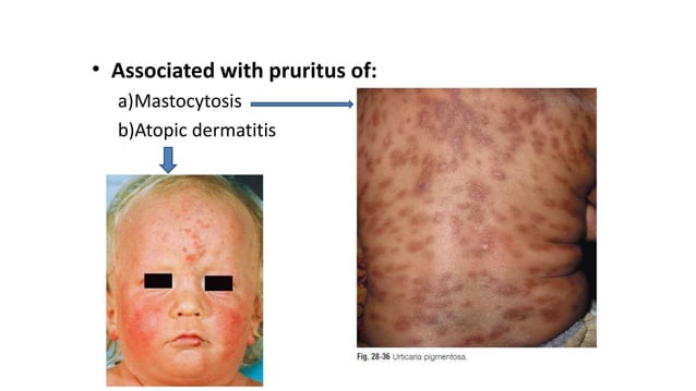 Pruritus and its mechanism | PPTX | Skin and Dermatology | Diseases and ...