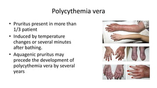 Pruritus and neurocutaneous dermatoses | PPTX