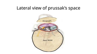 Prussak’s Space of middle ear and its ventilation.pptx