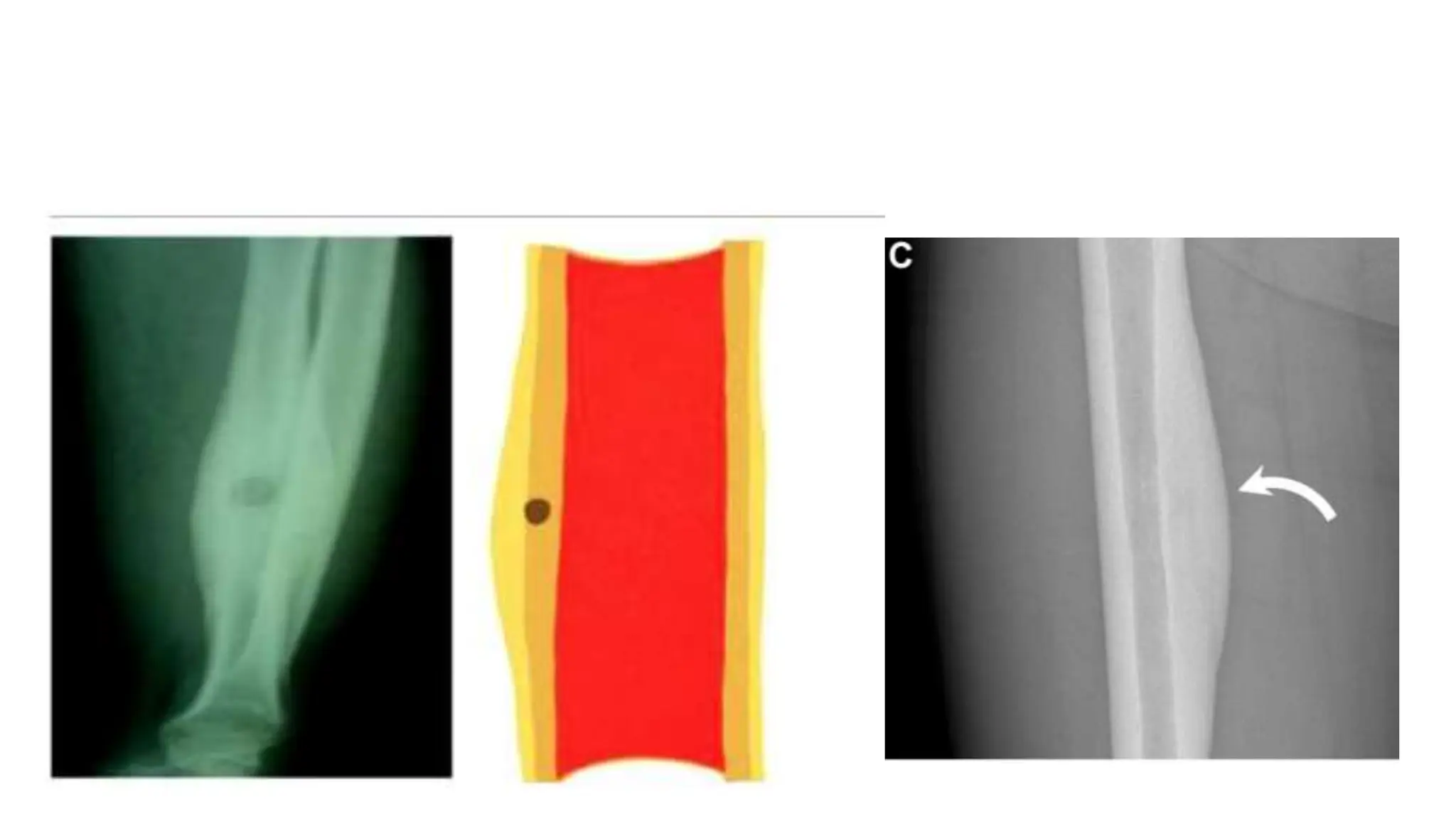 periosteal reaction radiology review.pptx
