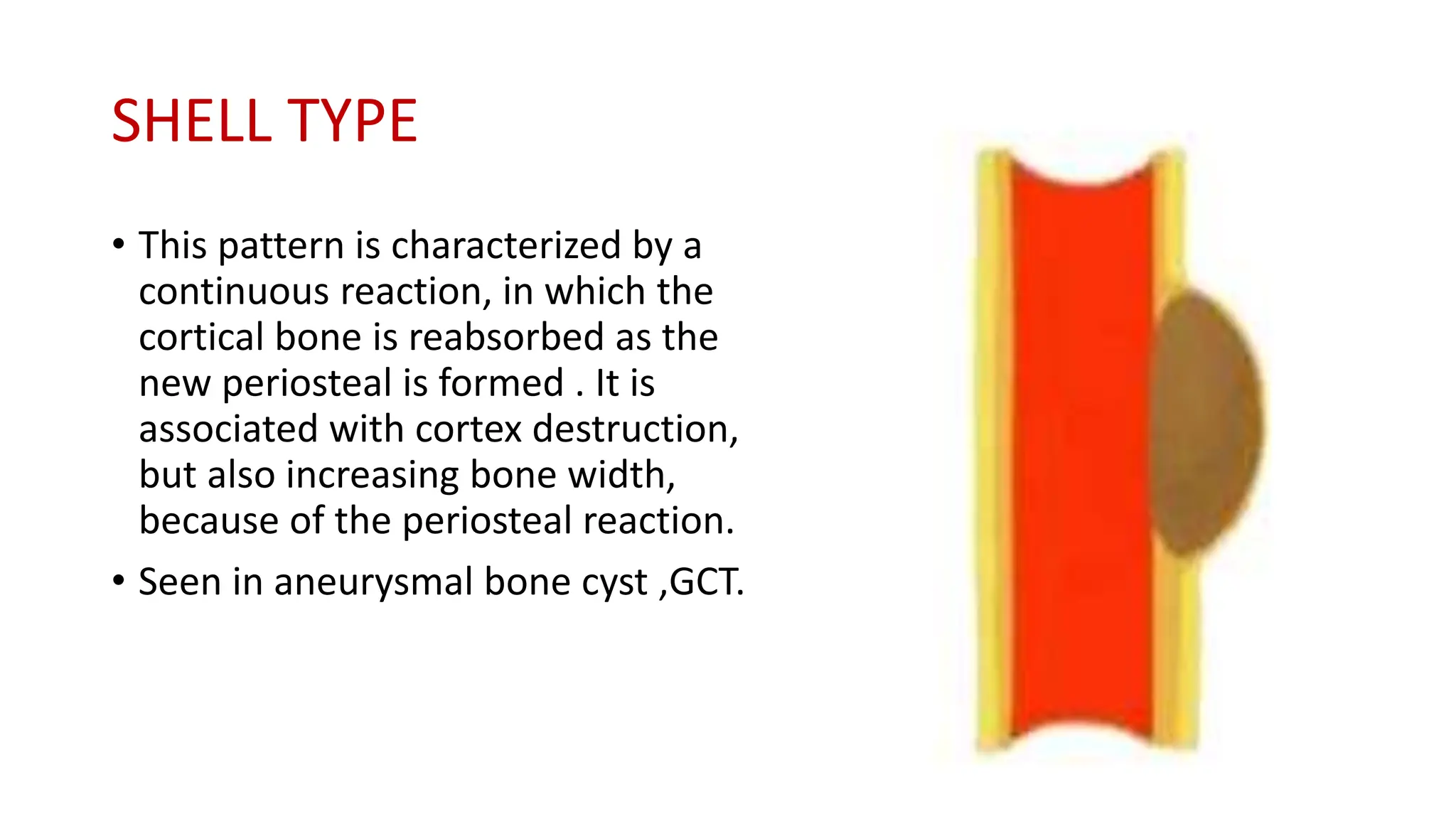periosteal reaction radiology review.pptx