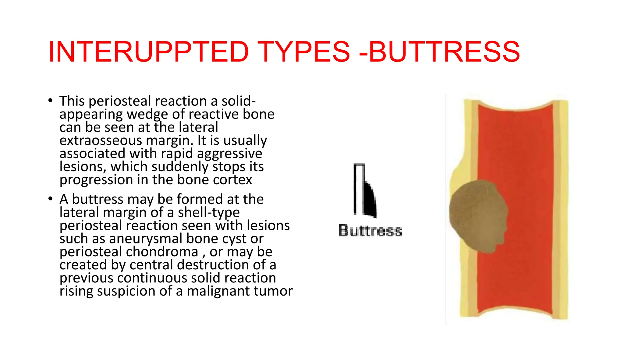 periosteal reaction radiology review.pptx