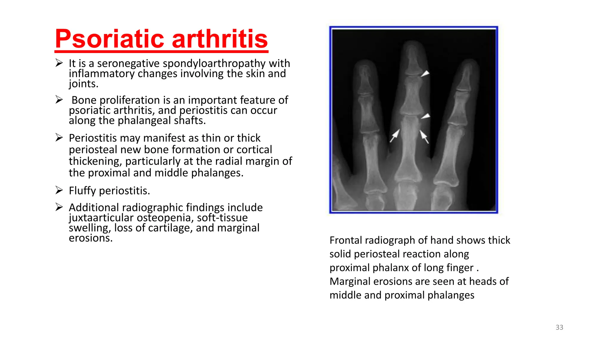 periosteal reaction radiology review.pptx