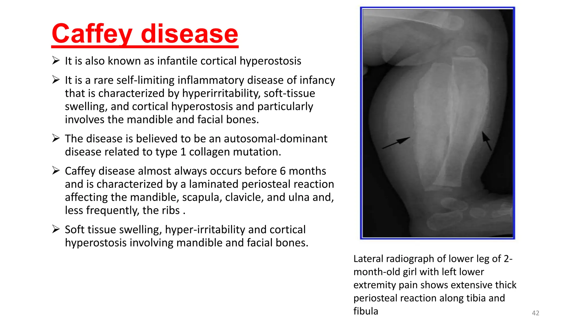 periosteal reaction radiology review.pptx