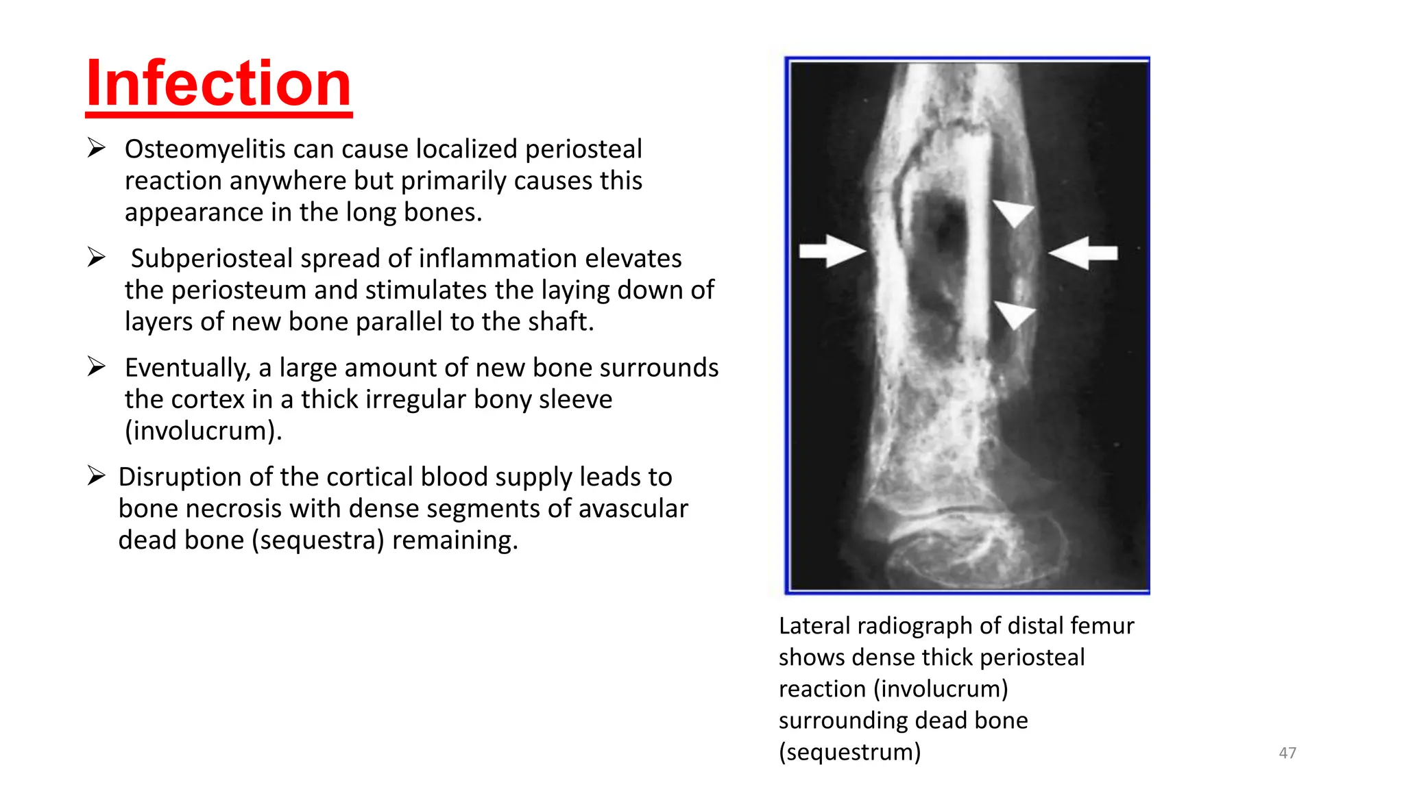 periosteal reaction radiology review.pptx