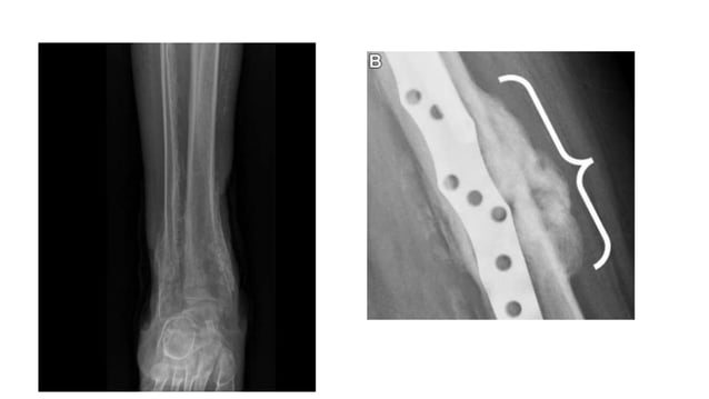 periosteal reaction radiology review.pptx