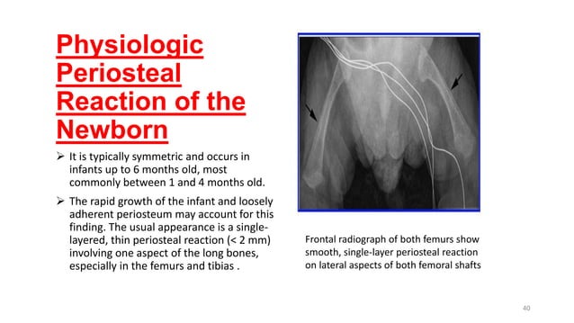 periosteal reaction radiology review.pptx
