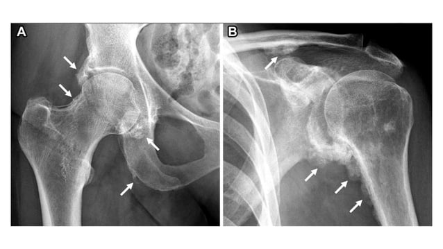 periosteal reaction radiology review.pptx