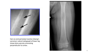 periosteal reaction radiology review.pptx