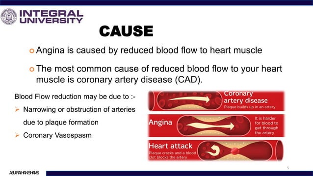 Angina and its types by Abu Raihan Shams | PDF