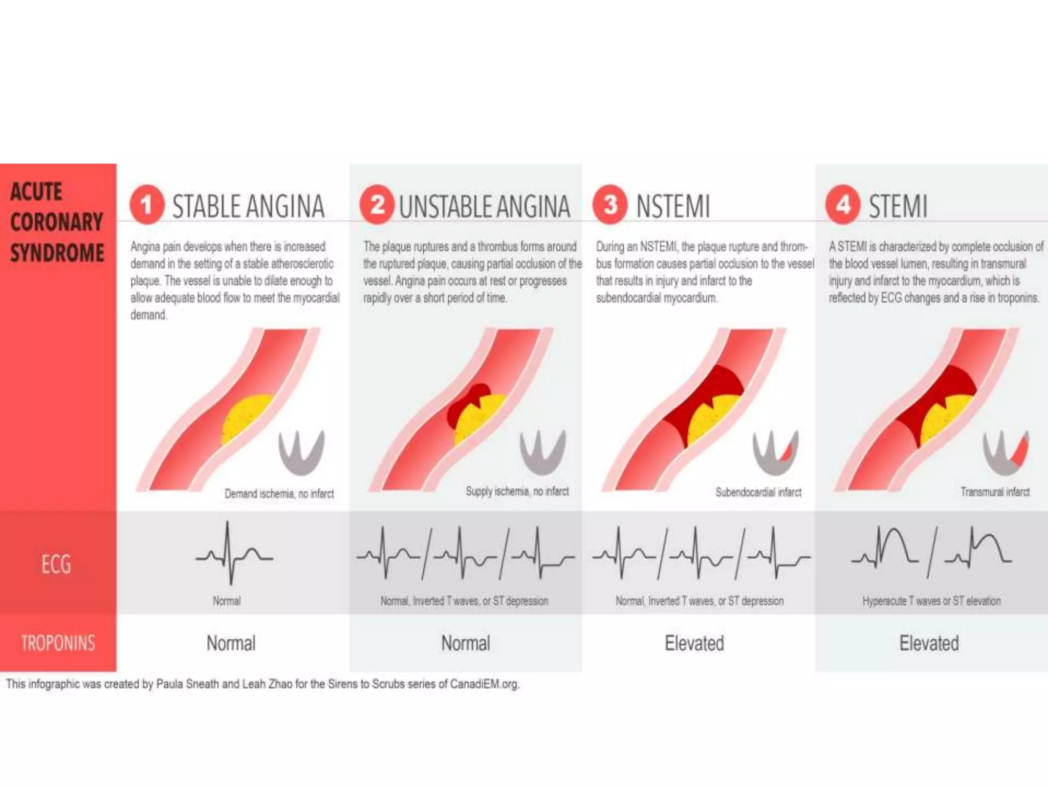 PHYSIOTHERAPY IN MYOCARDIAL INFARCTION | PPTX