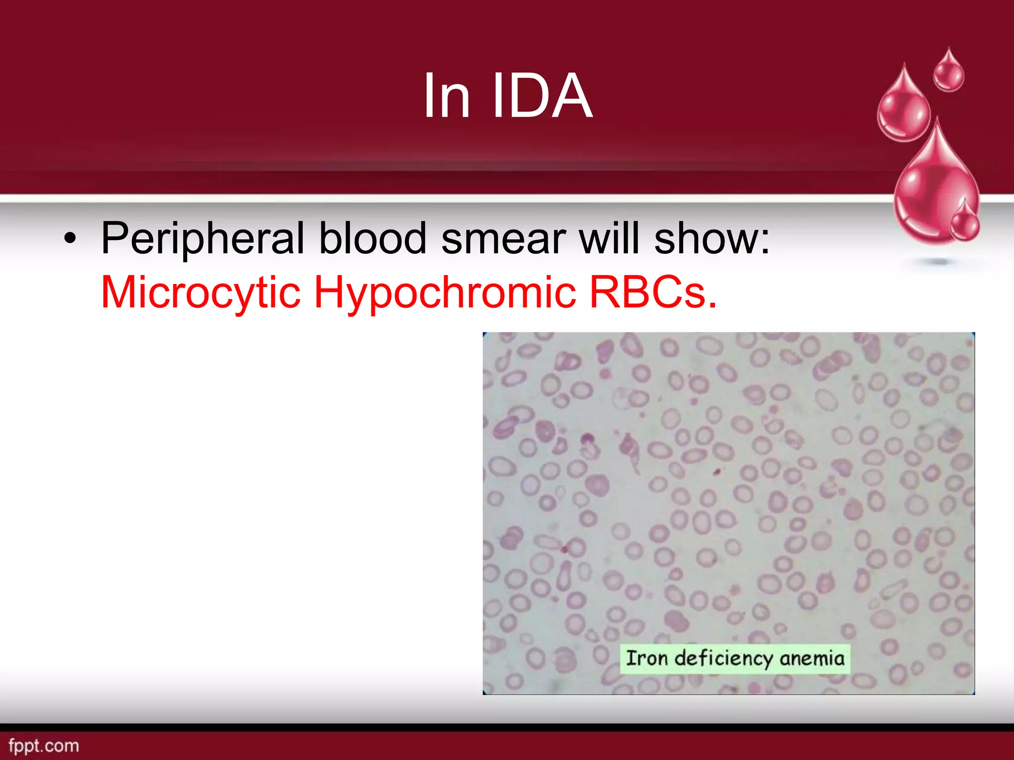 Approach to Iron Deficiency Anemia in Children | PPTX