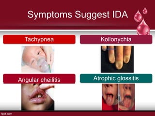 Approach to Iron Deficiency Anemia in Children | PPTX