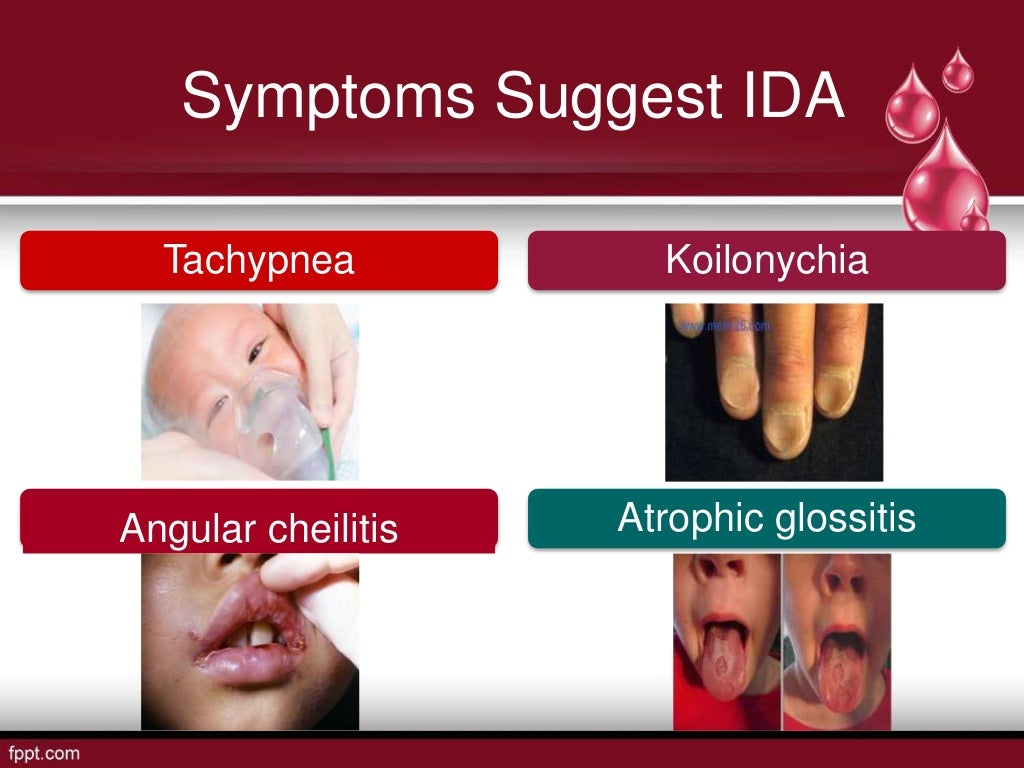 Approach to Iron Deficiency Anemia in Children