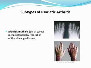 Psoriatic Arthritis and Connection to Diet: an Individualized Approach ...