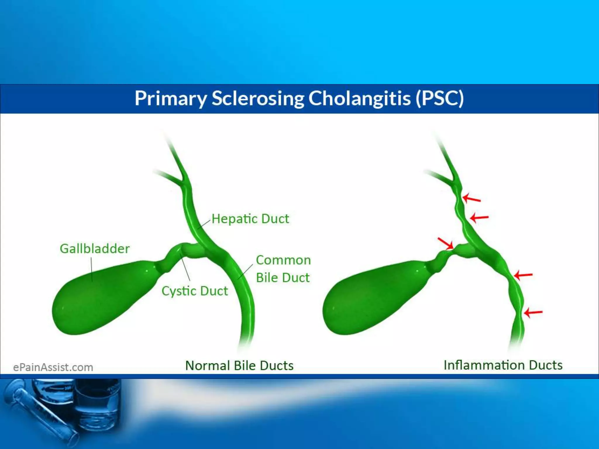 Primary Sclerosing Cholangitis (PSC) | PPTX