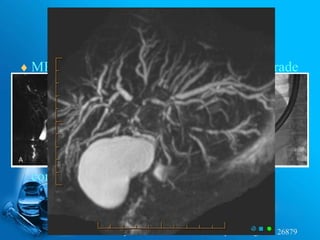 Primary Sclerosing Cholangitis (PSC) | PPTX